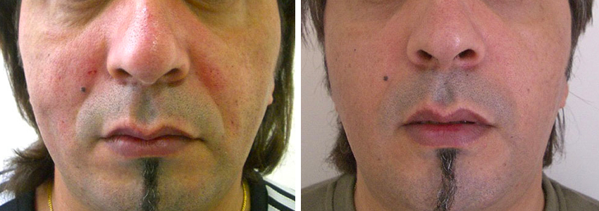 Archives des Avant après acide hyaluronique - Dr. Mayeux