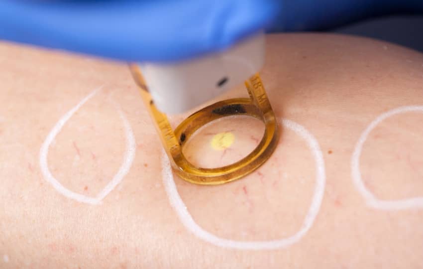 Comment traiter les varicosités des membres inférieurs au laser ...